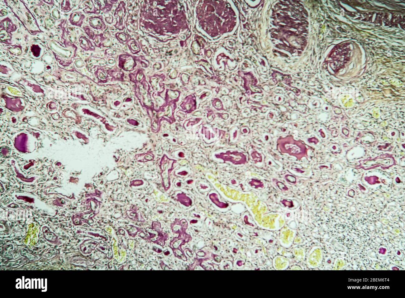 Shrinked kidney diseased tissue under the microscope 100x Stock Photo ...