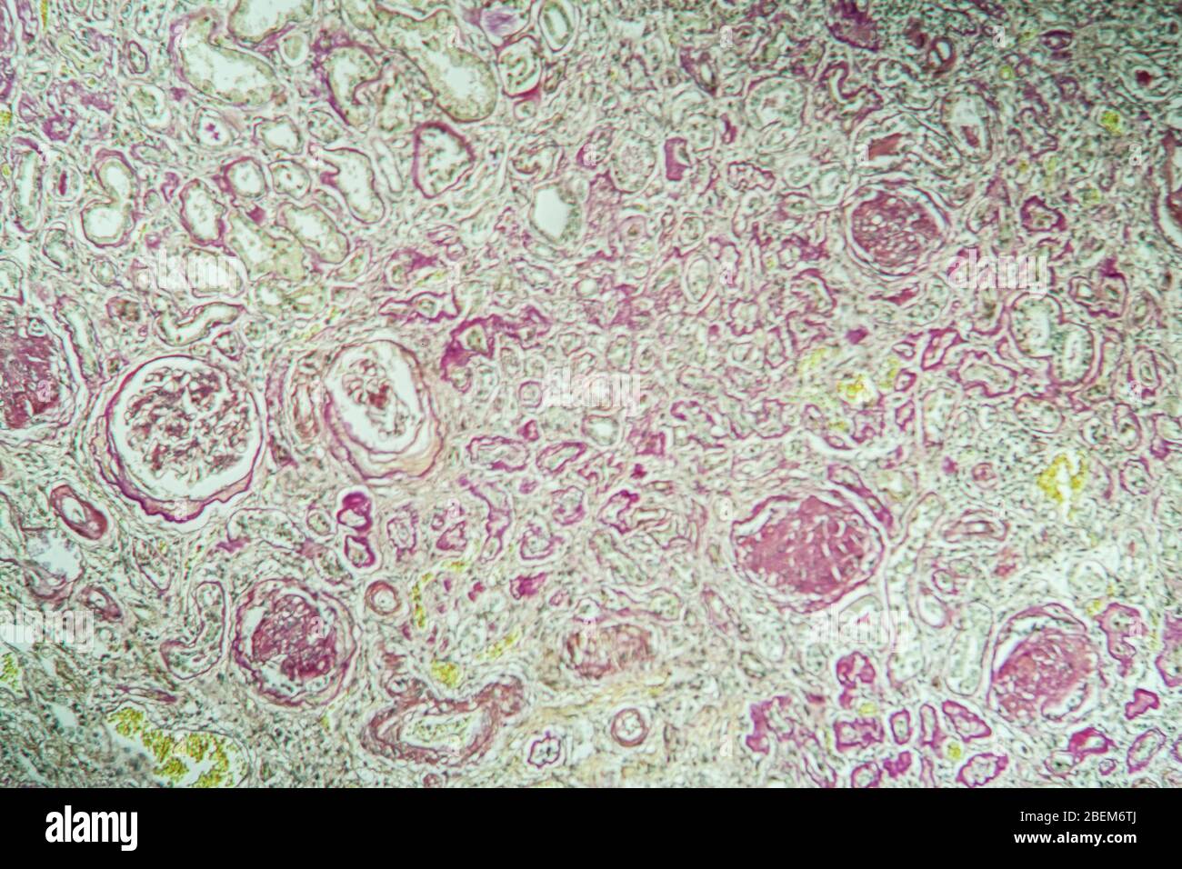Shrinked kidney diseased tissue under the microscope 100x Stock Photo ...