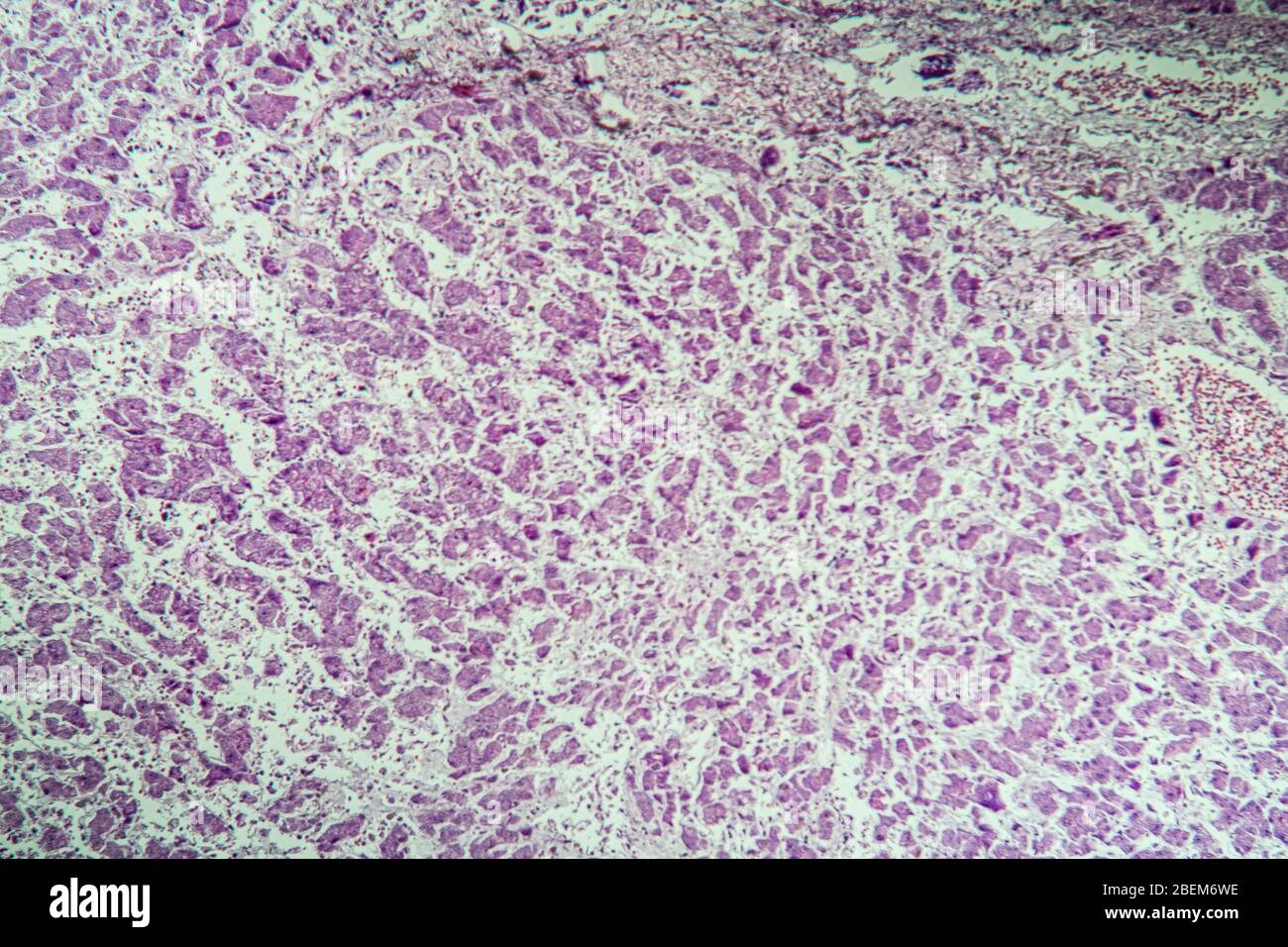 Liver carcinoma hi-res stock photography and images - Alamy