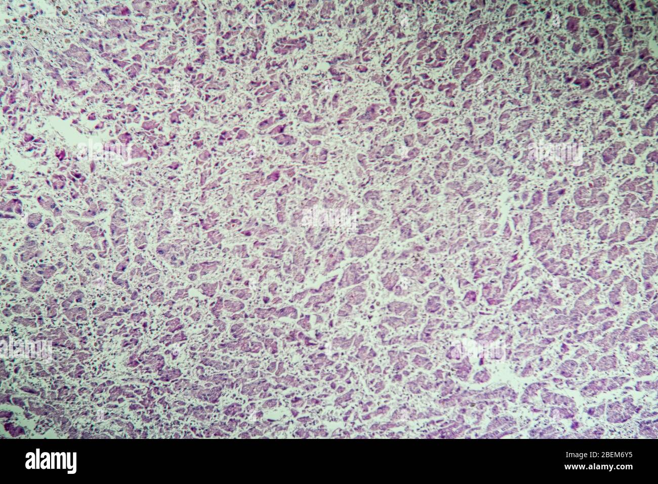 Liver carcinoma diseased tissue under the microscope 100x Stock Photo ...