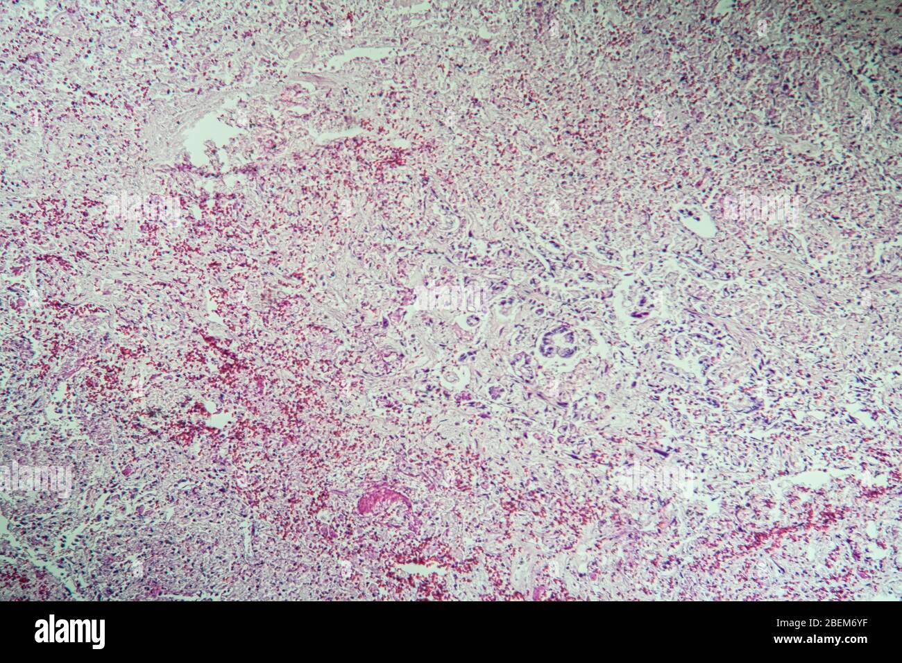 Liver carcinoma diseased tissue under the microscope 100x Stock Photo ...