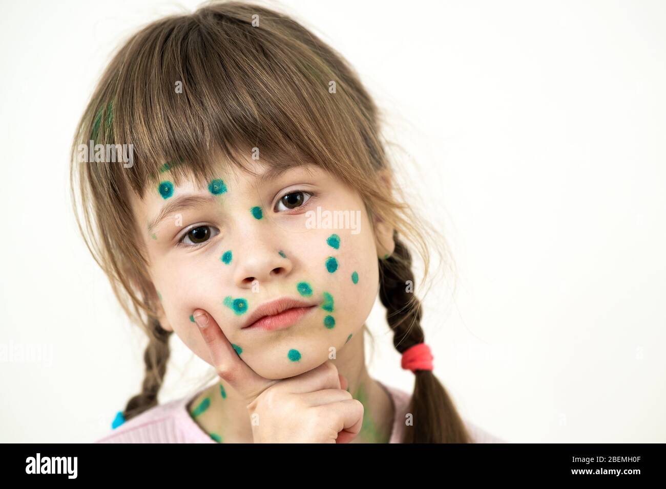 Child girl covered with green rashes on face ill with chickenpox ...