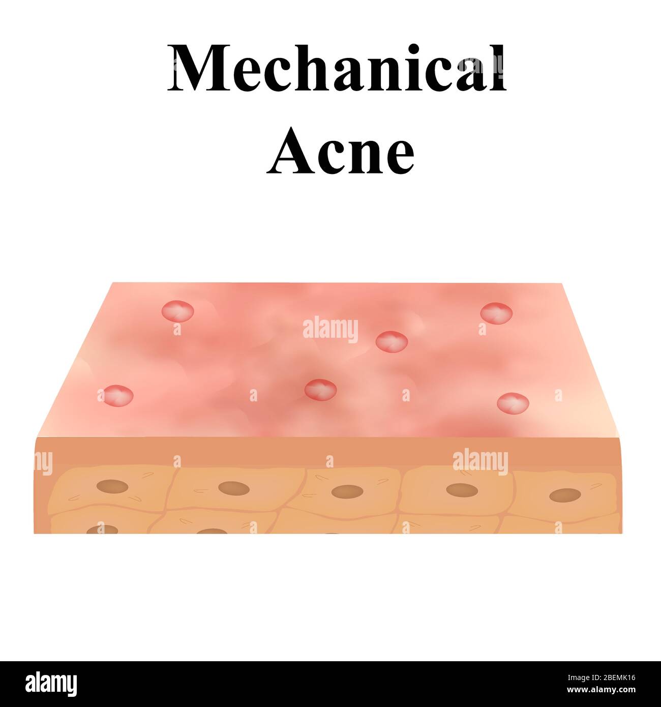 Closed comedones. Acne on the skin. Dermatological and cosmetic ...