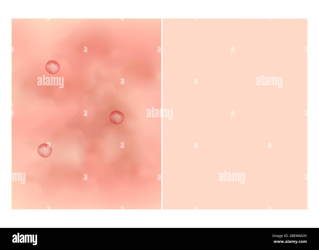Texture, inflamed pimples and acne. Before After acne cysts. Skin ...