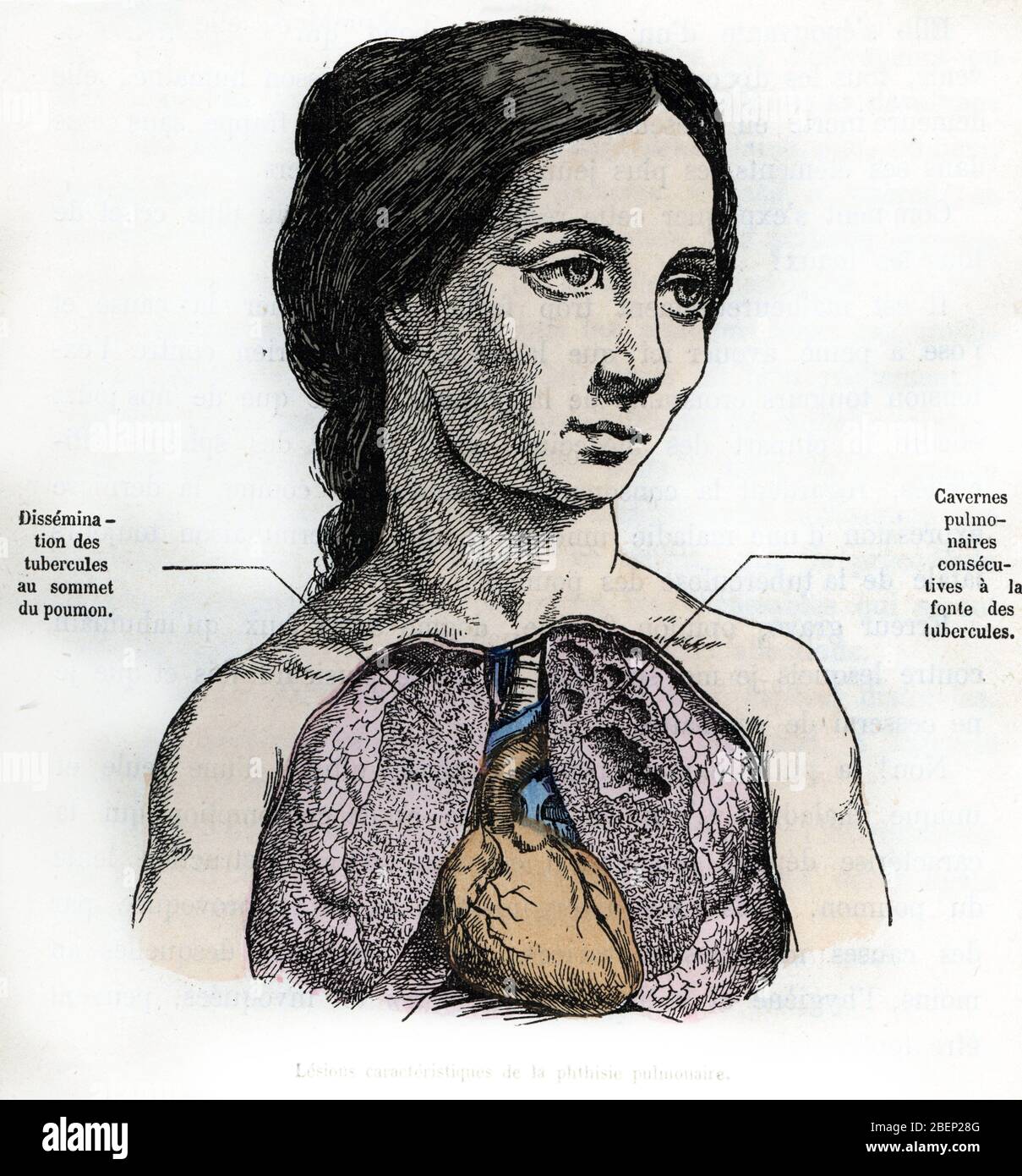 Maladie pulmonaire hi-res stock photography and images - Alamy