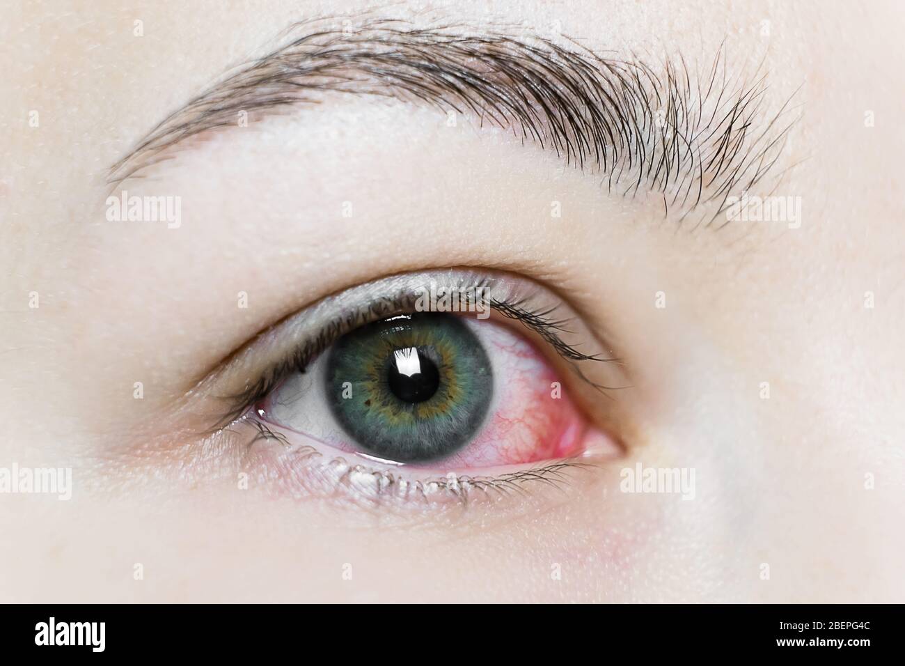 Blepharitis hi-res stock photography and images - Alamy