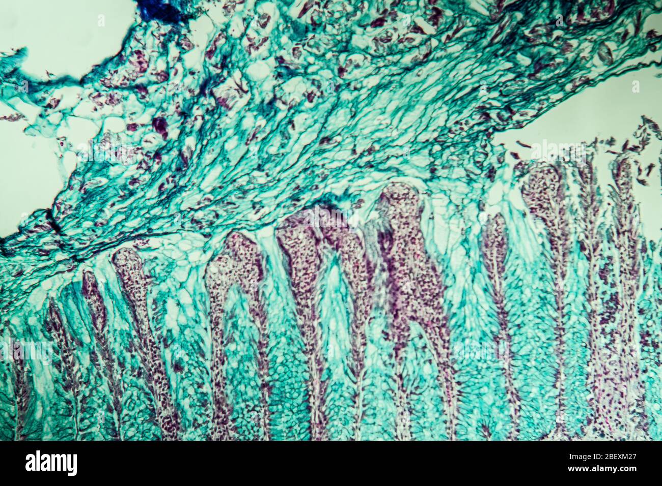 Colon carcinoma tissue under the microscope 100x hi-res stock ...