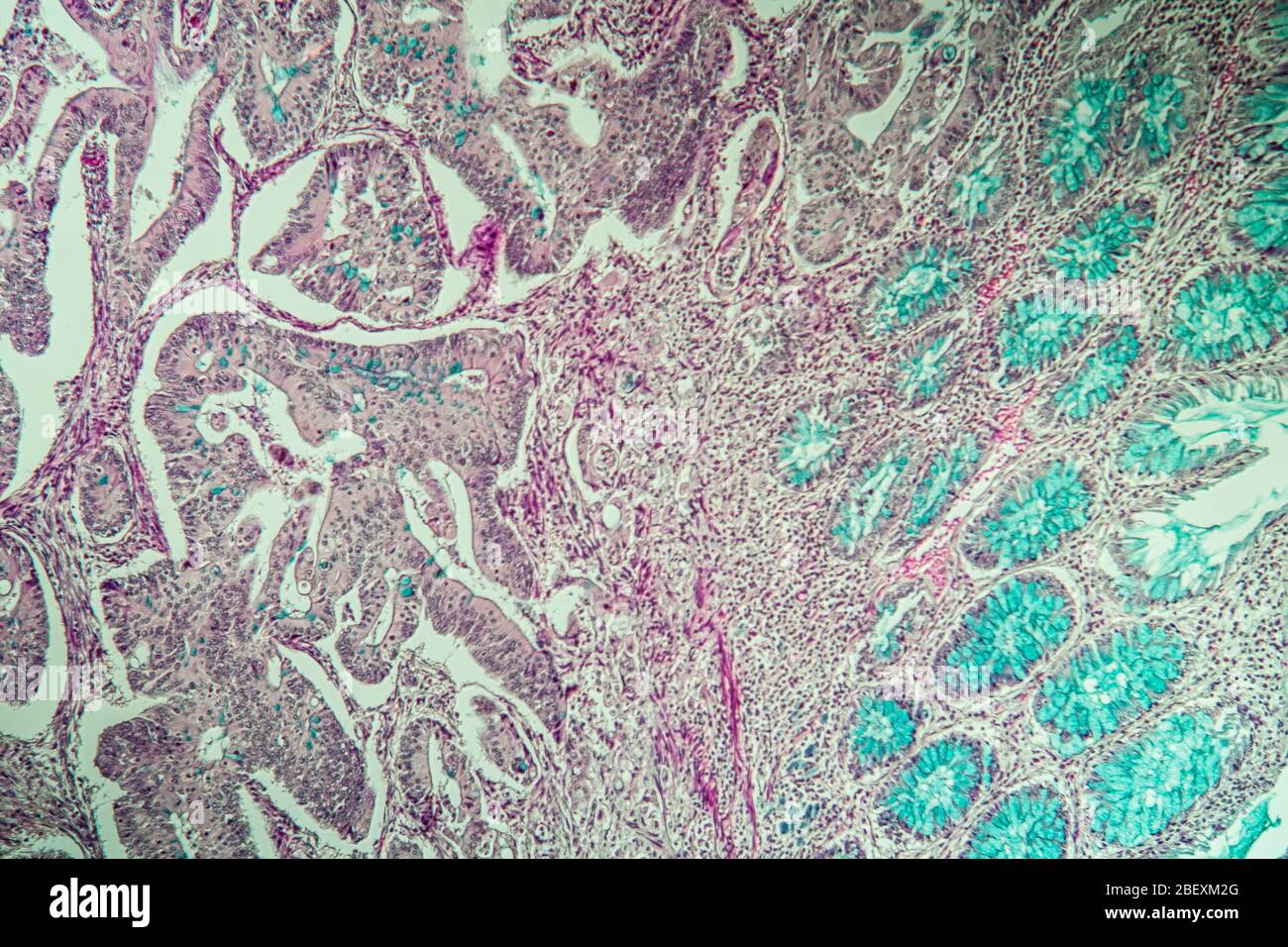 Colon carcinoma tissue under the microscope 100x hi-res stock ...