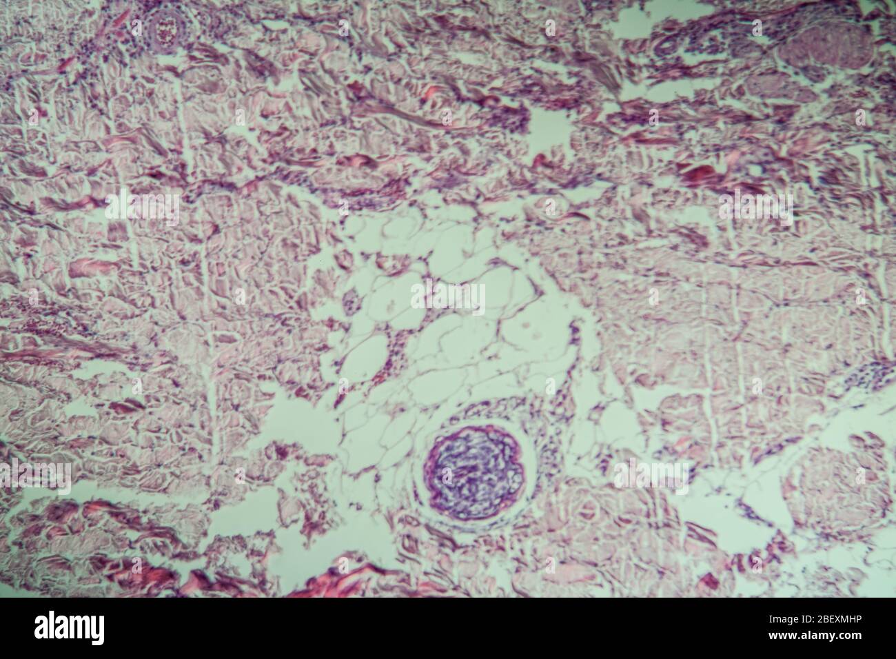 Chickenpox infection tissue under the microscope 100x Stock Photo - Alamy