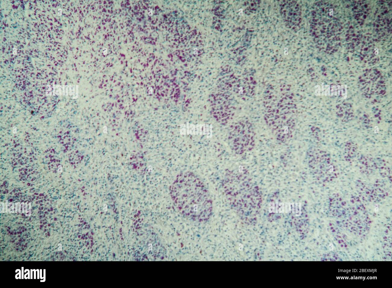 AIDS with fungi 100x infected tissue Stock Photo - Alamy