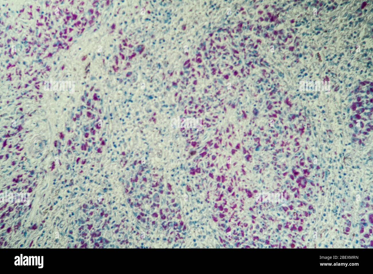 AIDS with fungi 200x infected tissue Stock Photo - Alamy