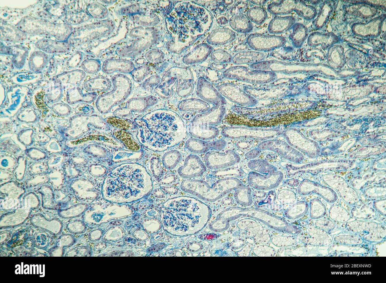 Fibrin deposits in the kidney, microscopy 100x Stock Photo - Alamy