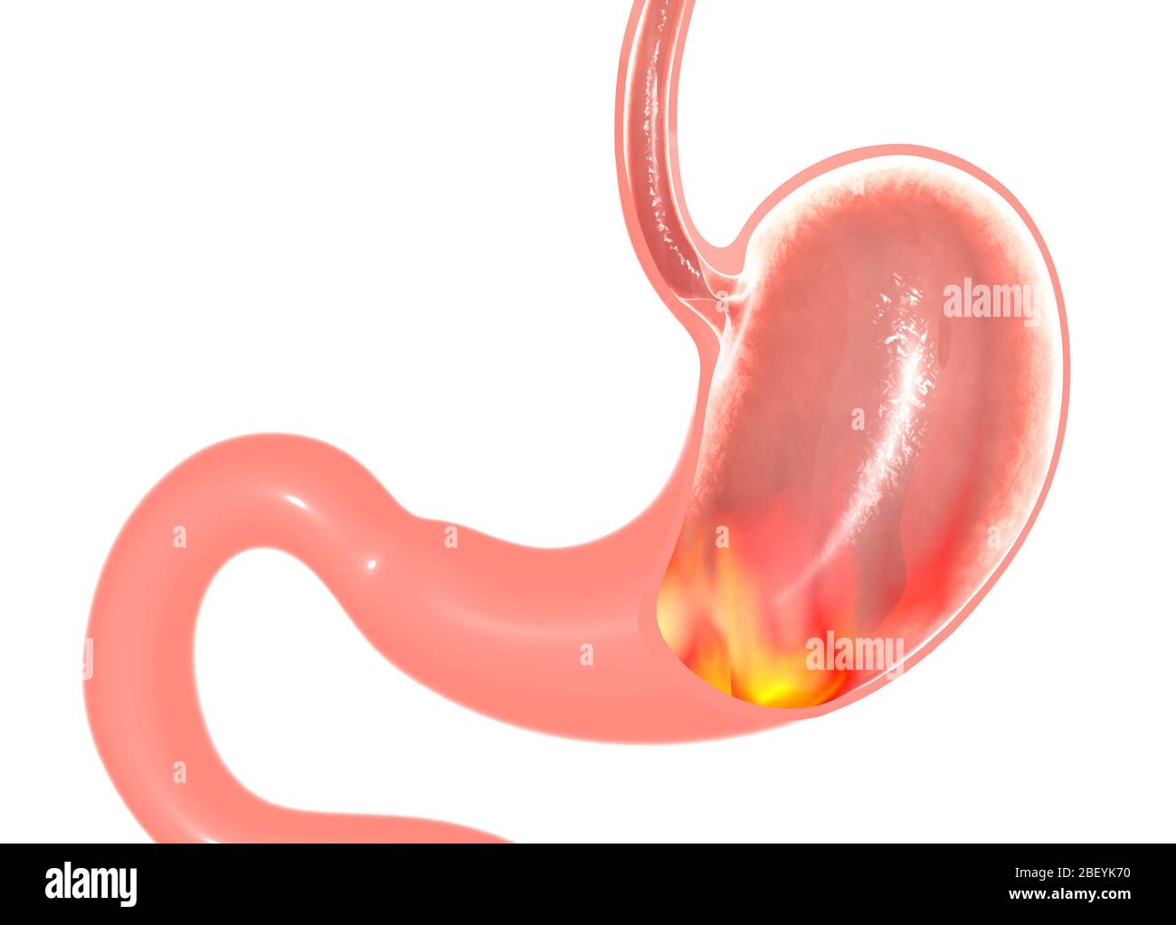 3D illustration of the internal anatomy of the stomach with heartburn ...