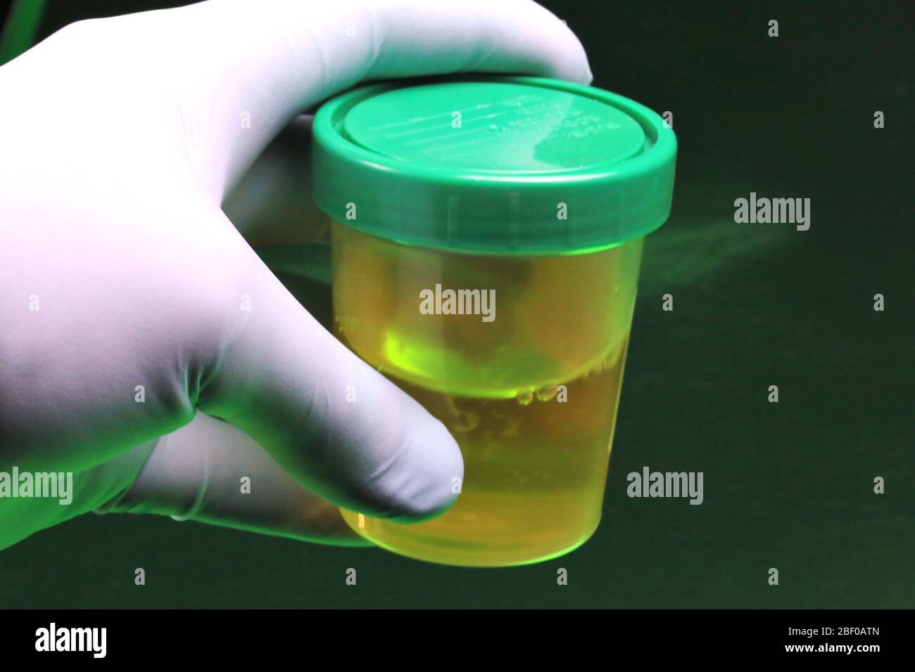 Urine test sample bottle being reviewed for toxicology Stock Photo - Alamy