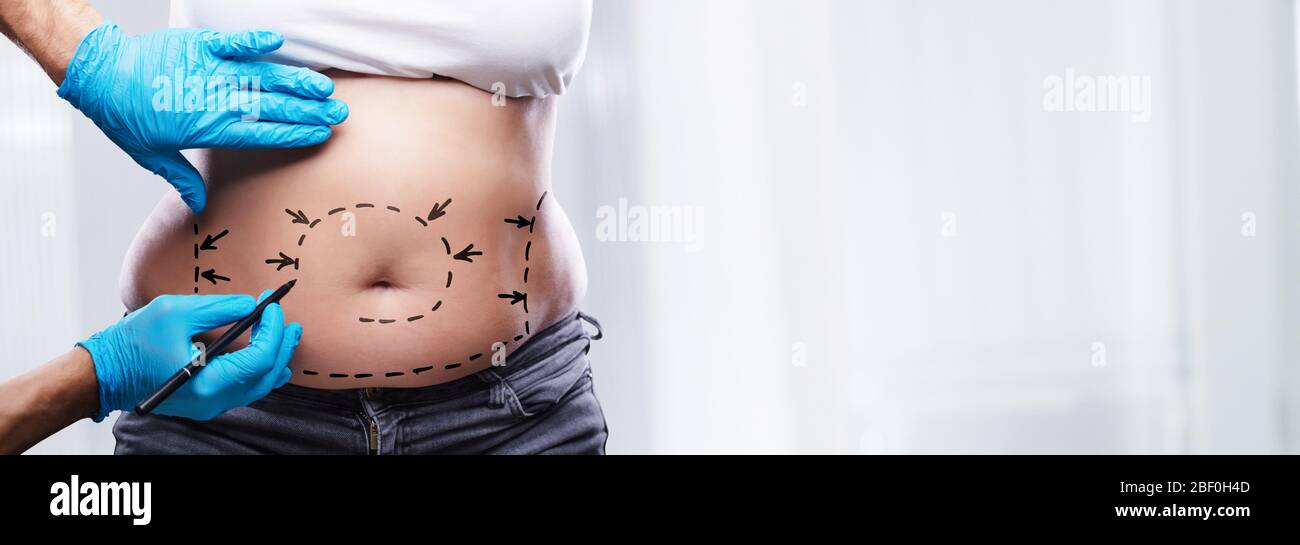 Liposuction man stomach hi-res stock photography and images - Alamy