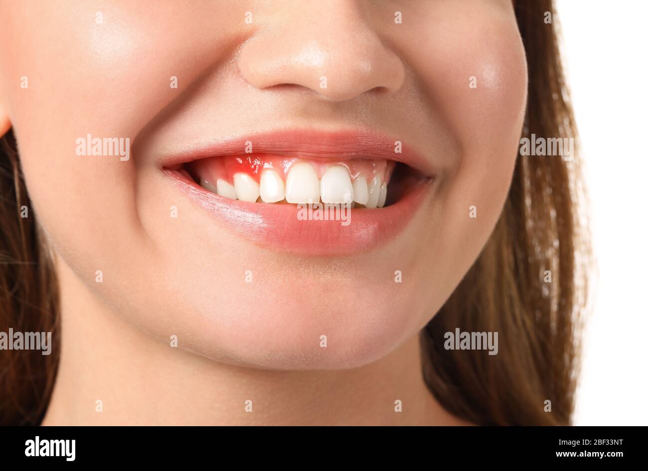 Gum disease woman hi-res stock photography and images - Alamy