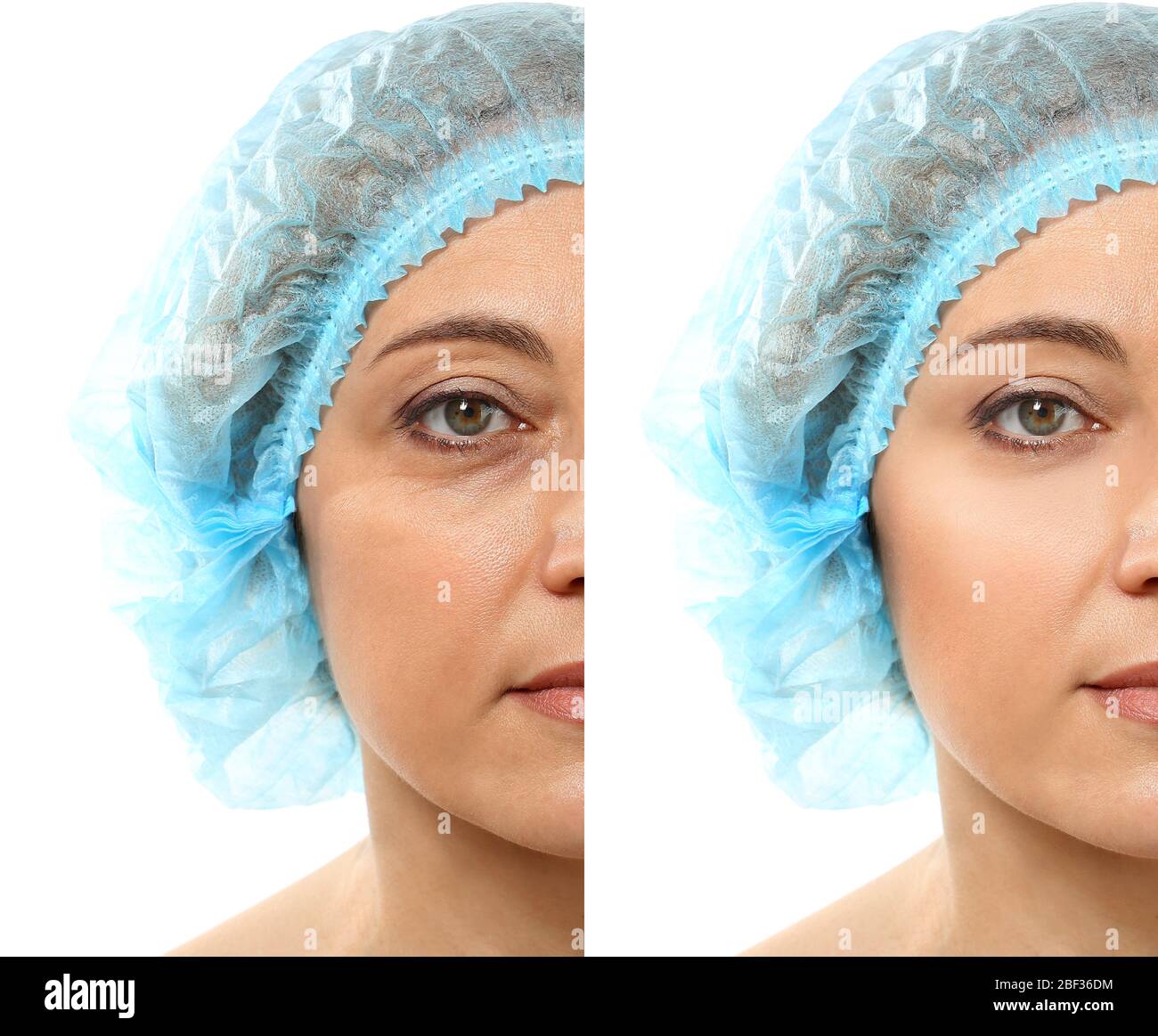 Woman before and after plastic surgery on white background Stock Photo ...