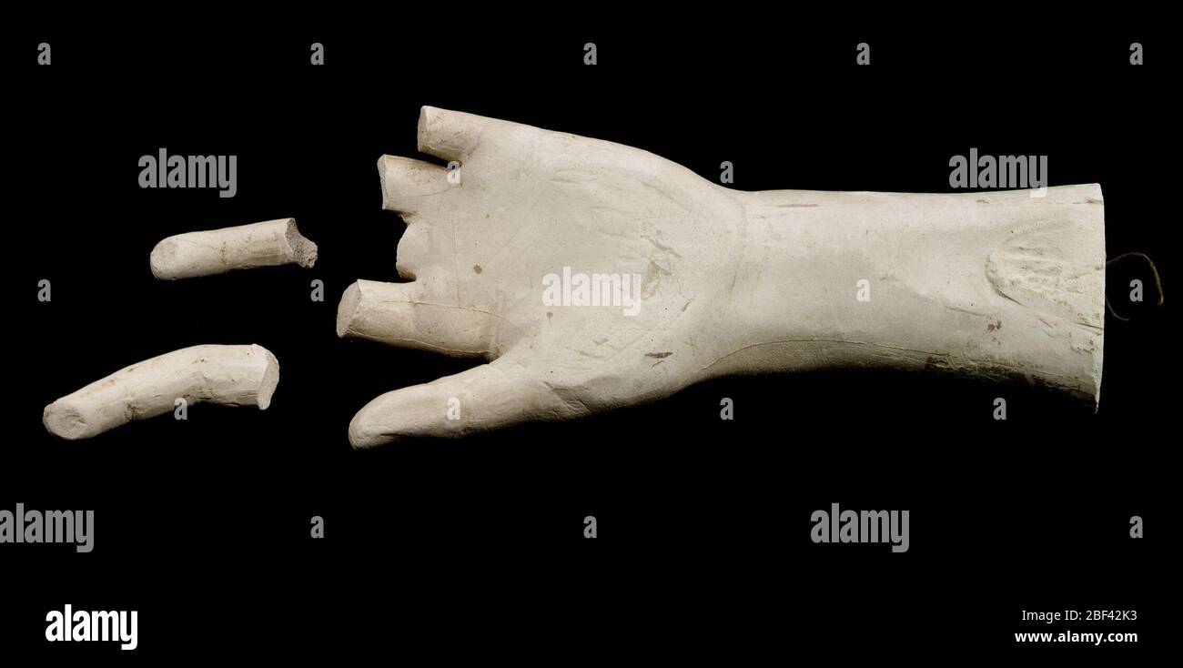 Cast of an Unidentified Childs Left Hand two fingers partially missing ...