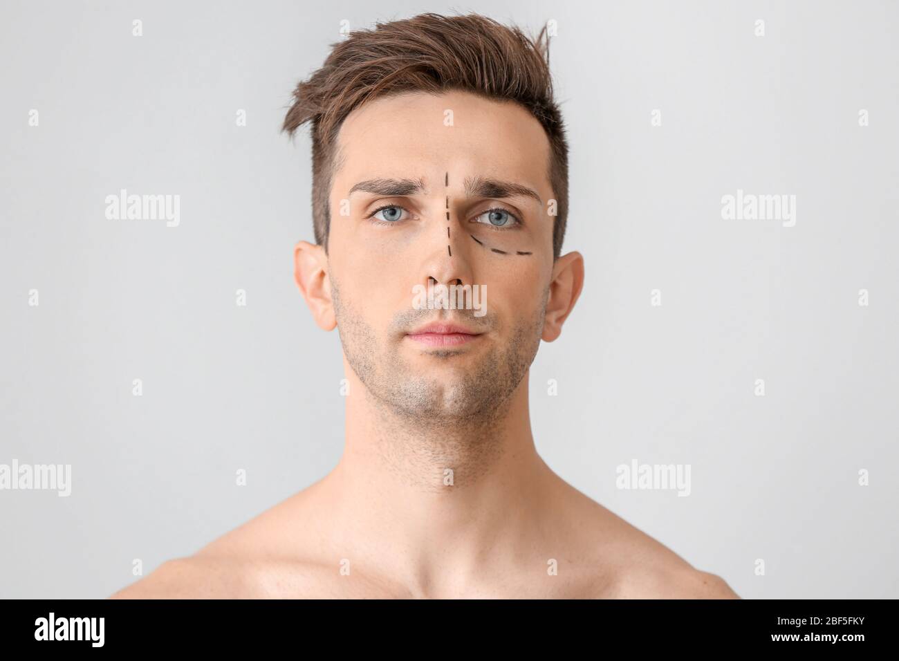 Young man with marks on his face against light background. Concept of ...