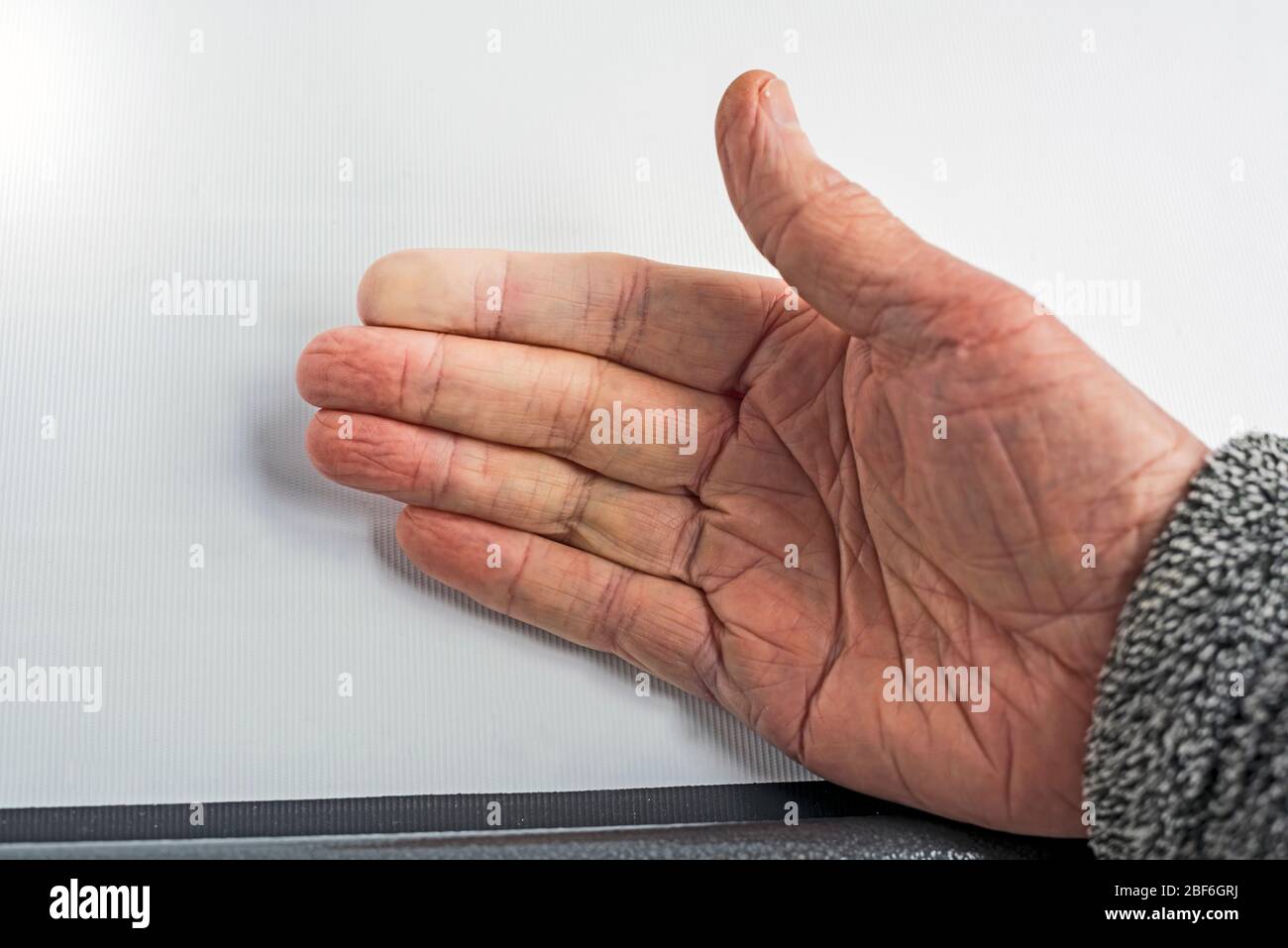 Palmar aspect of elderly right hand exhibiting Raynaud’s phenomenon in ...