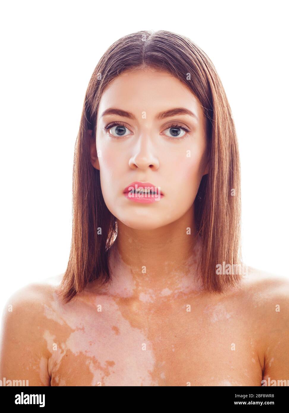 beautiful young brunette woman with vitiligo disease close up isolated ...