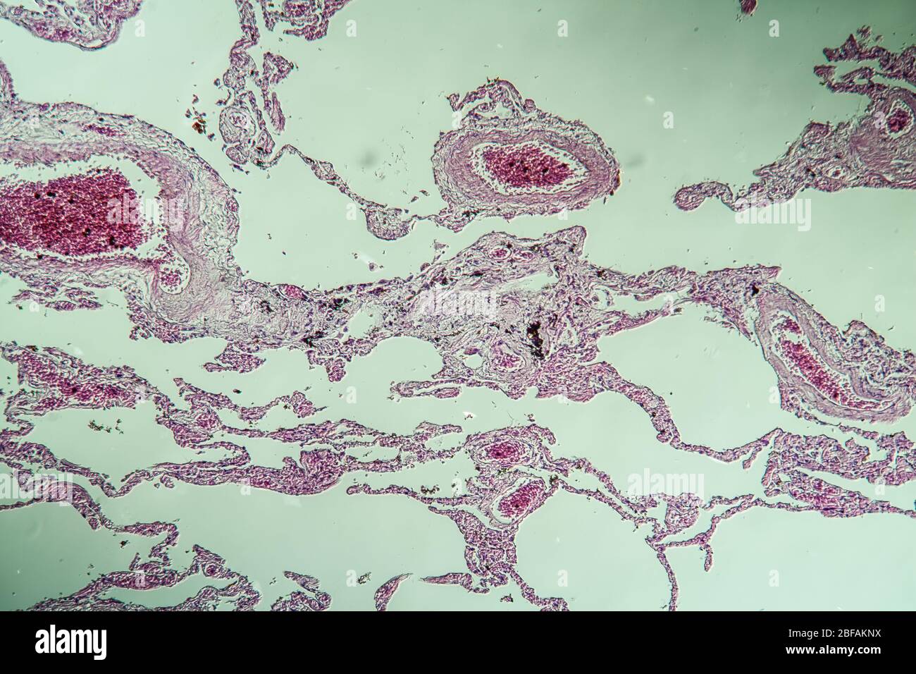 Tissue contaminated with asbestosis 100x Stock Photo - Alamy