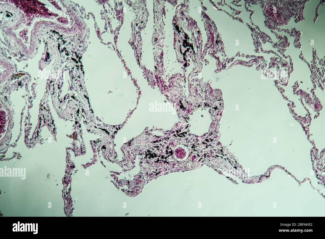 Tissue contaminated with asbestosis 100x Stock Photo - Alamy