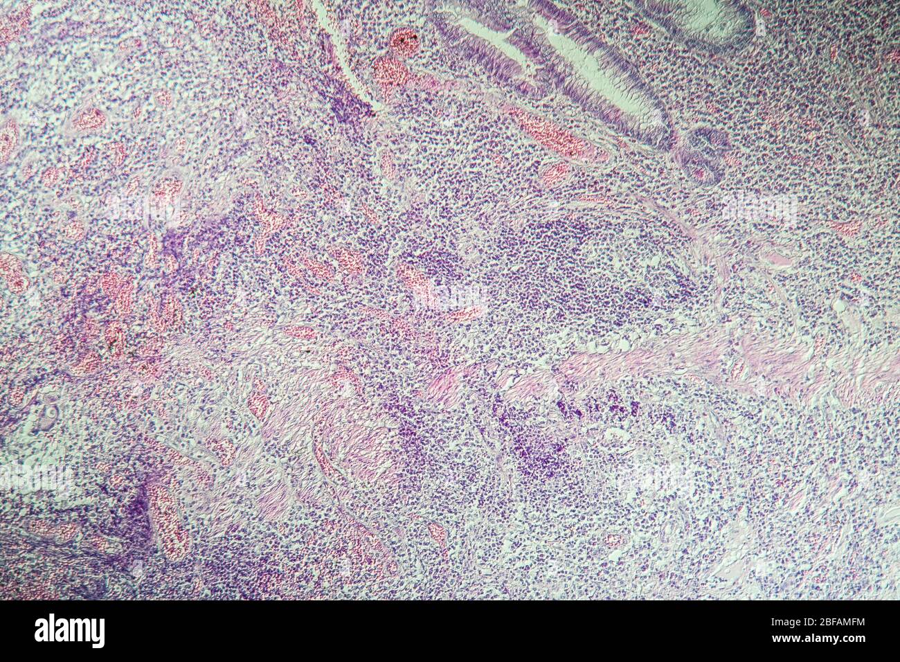 Crohns disease hi-res stock photography and images - Alamy