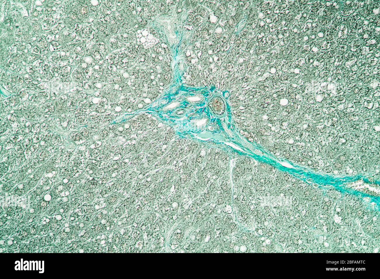 Enlargement liver hi-res stock photography and images - Alamy