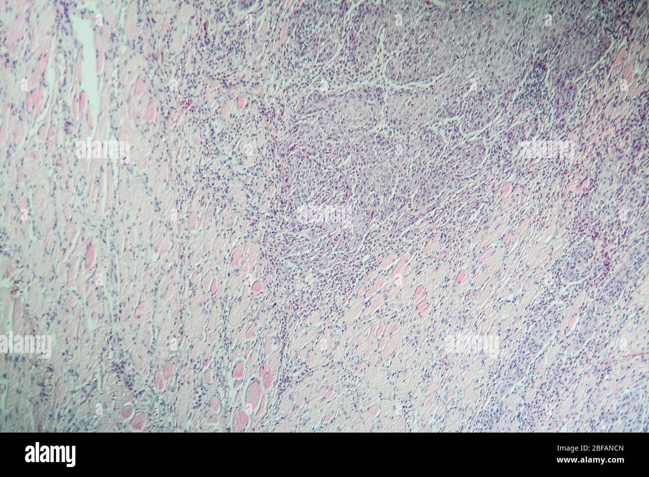 Skin ulcer carcinoma enlarged 100x Stock Photo - Alamy