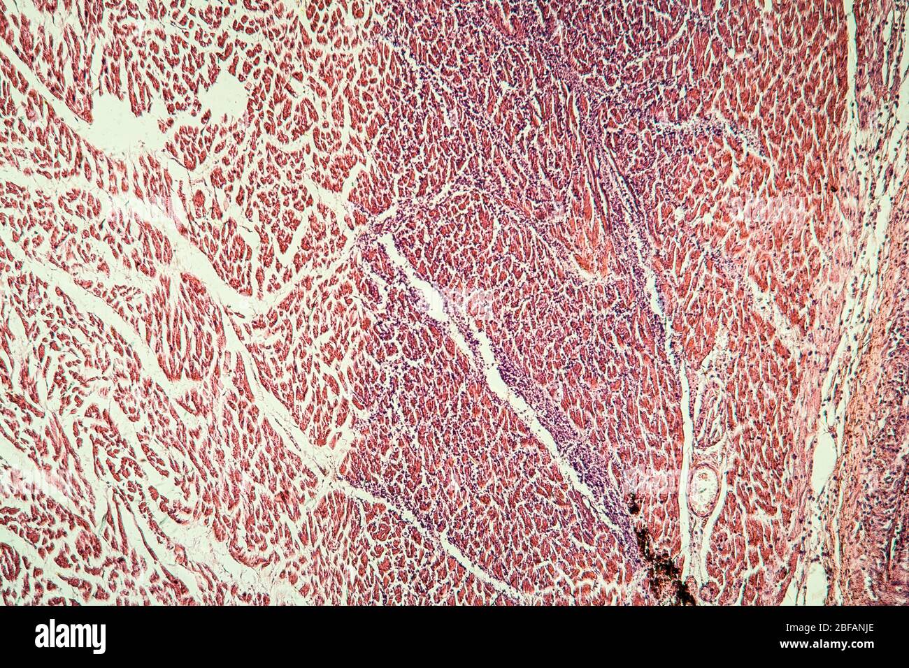 Cardiac muscle after infarction, tissue section 100x Stock Photo - Alamy