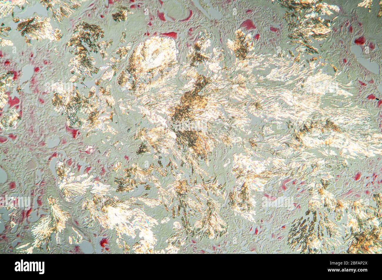 Arthritis gout crystals in the cells tissue section 100x Stock Photo ...