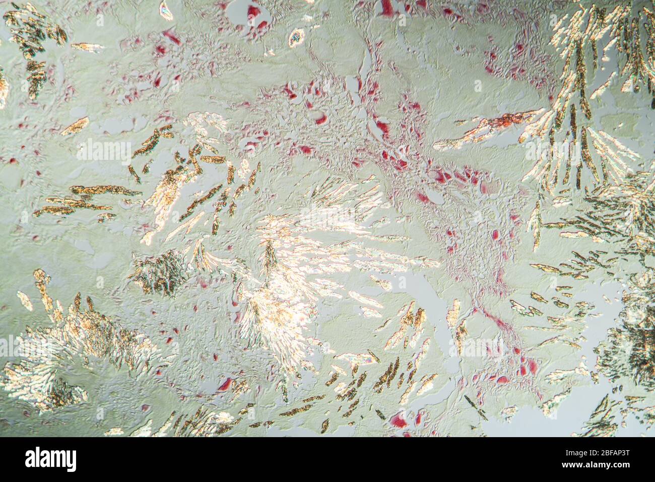 Arthritis gout crystals in the cells tissue section 100x Stock Photo ...