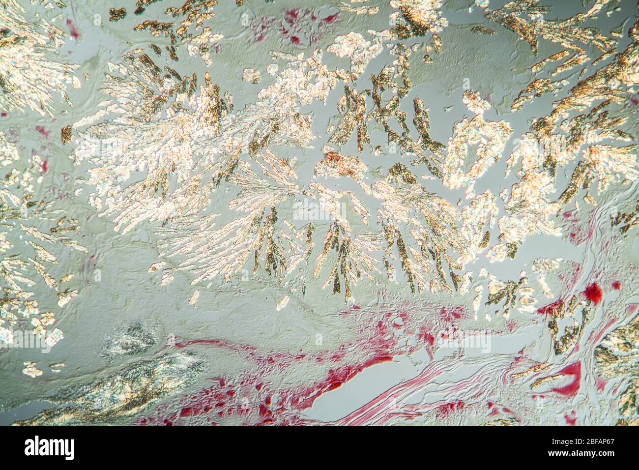 Arthritis gout crystals in the cells tissue section 100x Stock Photo ...
