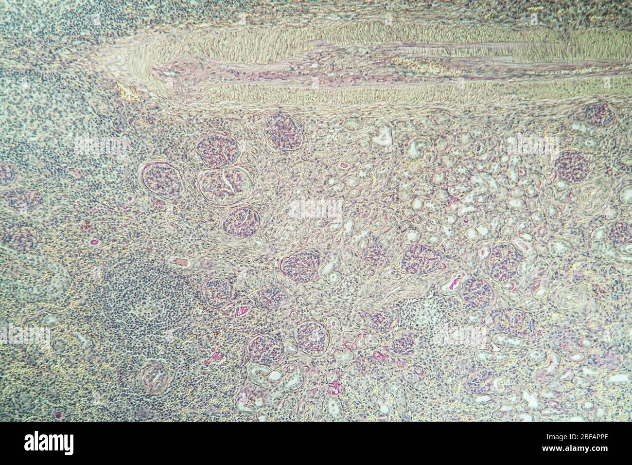Hydronephrosis kidney inflammation in tissue section 100x Stock Photo ...