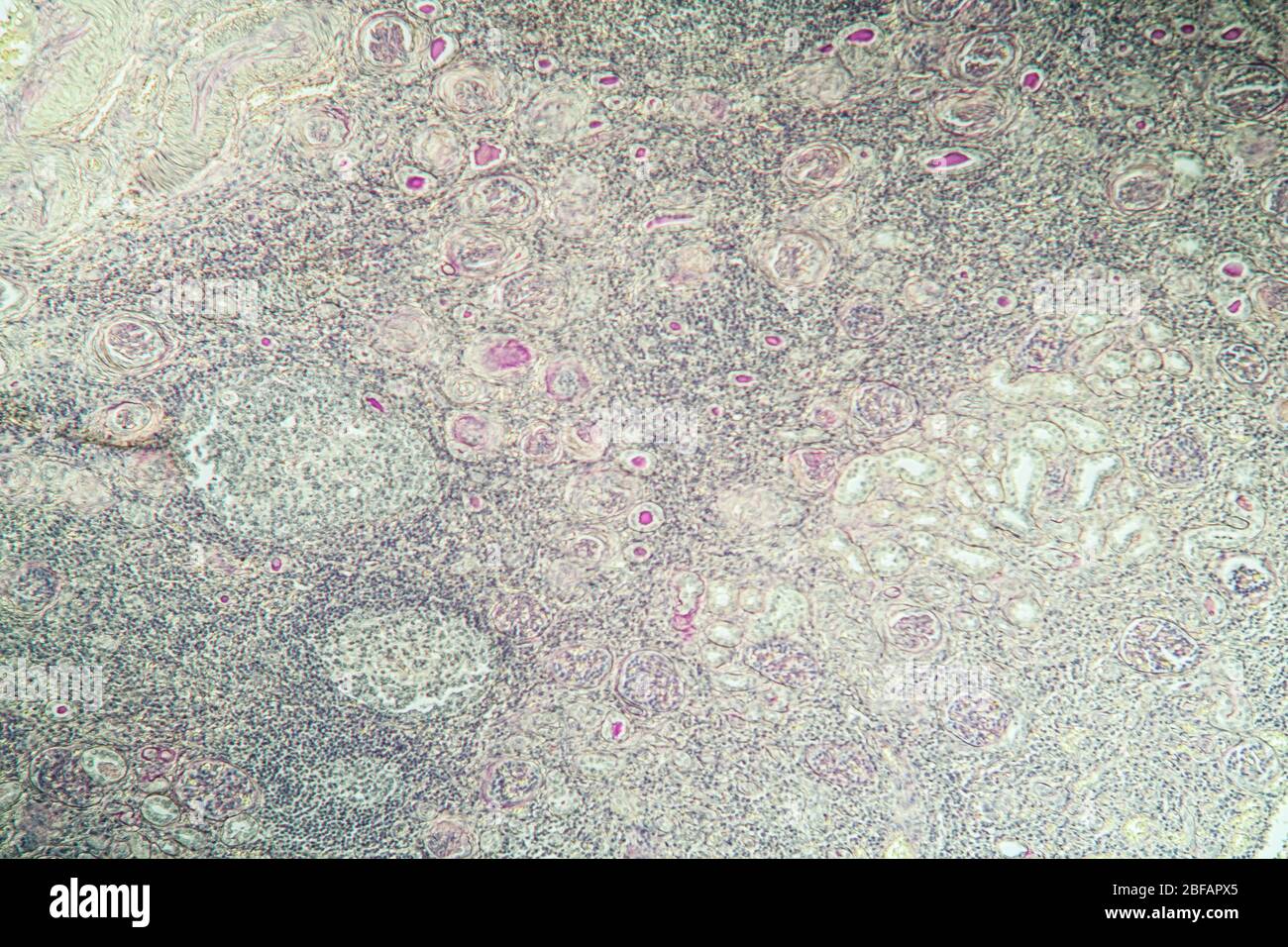 Hydronephrosis hi-res stock photography and images - Alamy