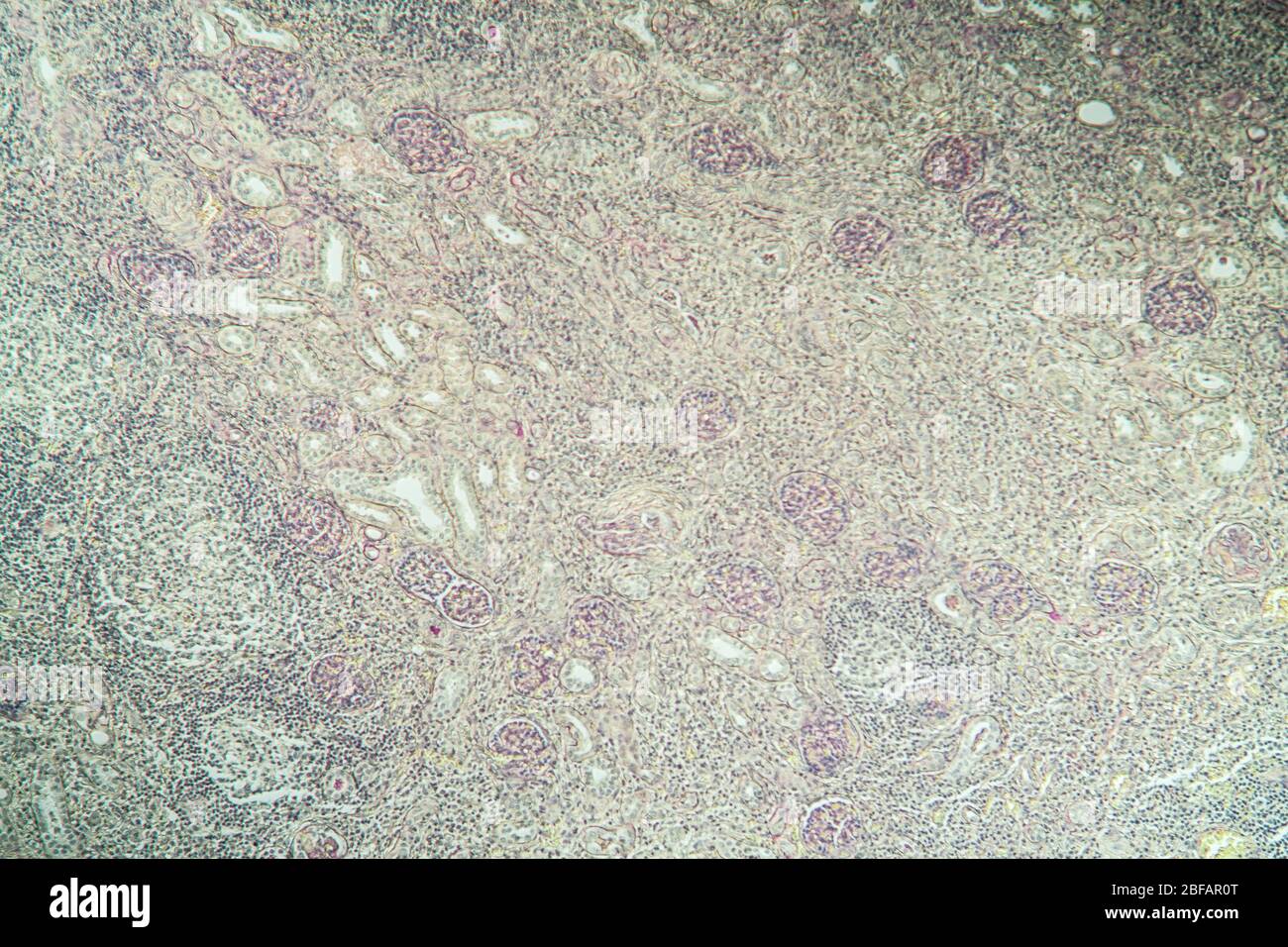 Hydronephrosis hi-res stock photography and images - Alamy