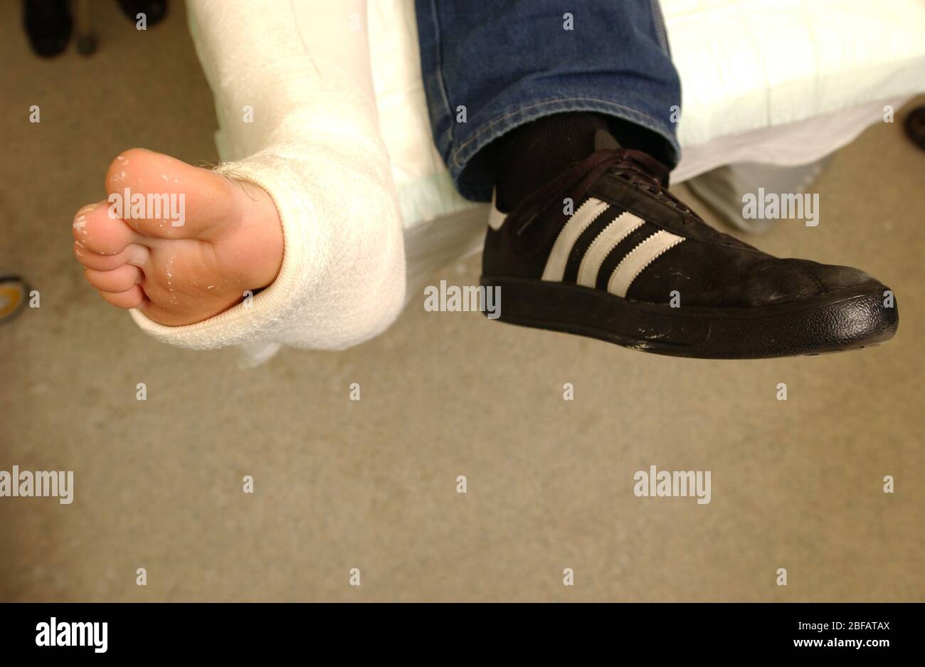 Close up of patient’s feet – one in plaster, the other wearing a black ...
