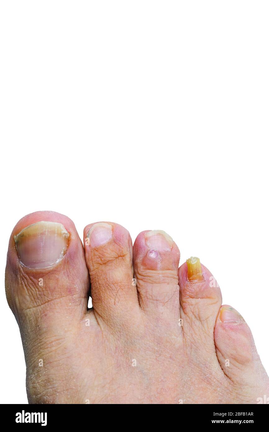 Deformed toenail hi-res stock photography and images - Alamy
