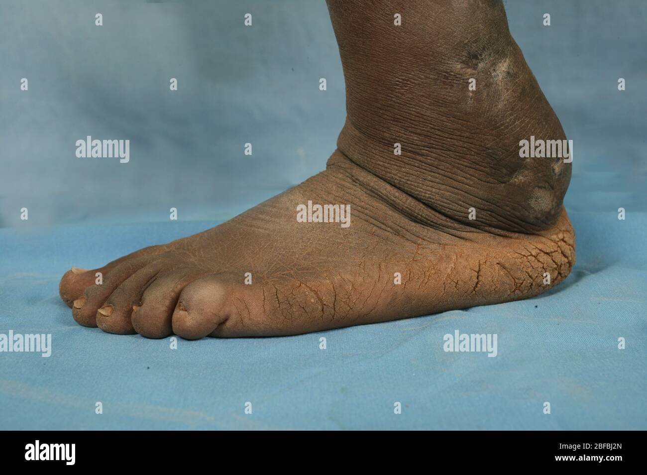 Lateral view of Eumycetoma of the left ankle. Mycetoma is an uncommon ...