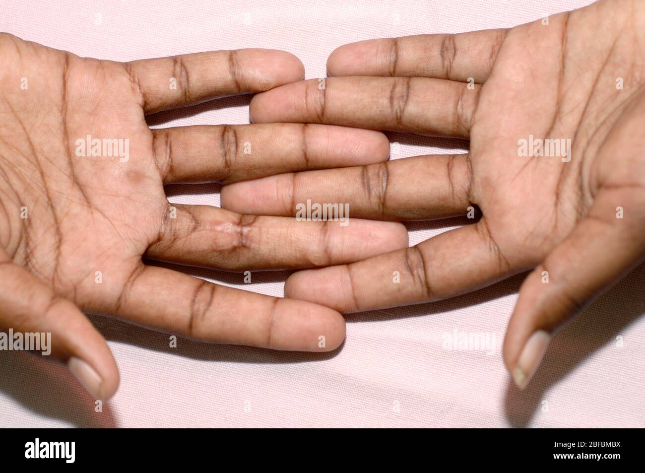 Close up of warts on the hand of a young teenage boy. This is caused by ...