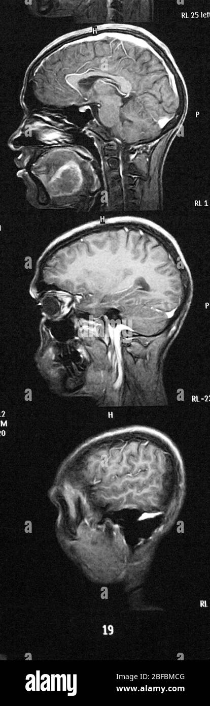 Multiple myeloma skull Black and White Stock Photos & Images - Alamy