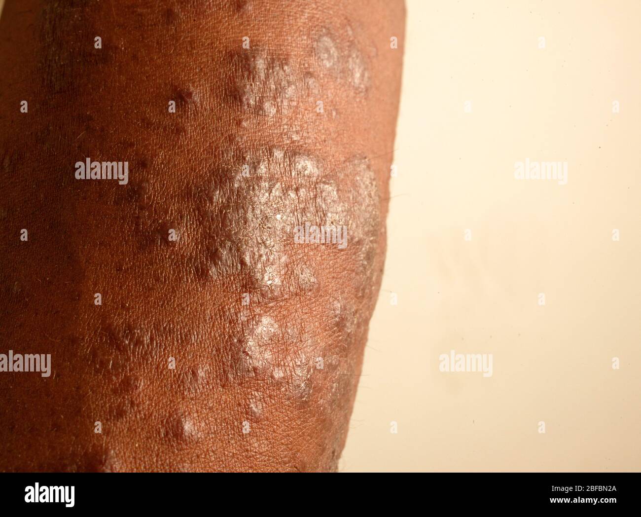 Skin lesion hi-res stock photography and images - Alamy
