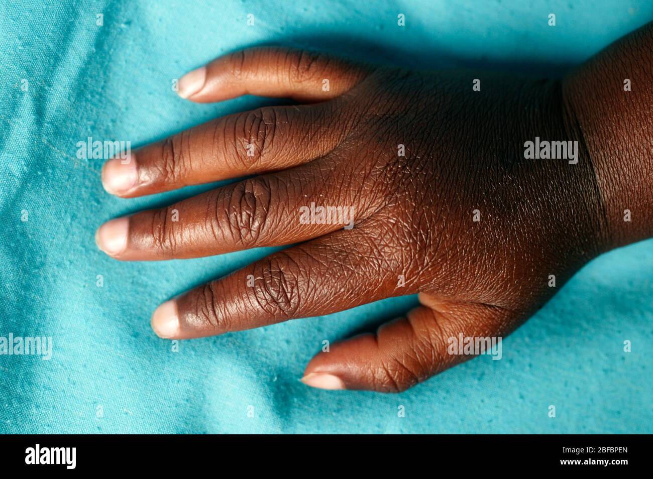 Child's hand suffering from Oedematus malnutrition and clubbing of the ...