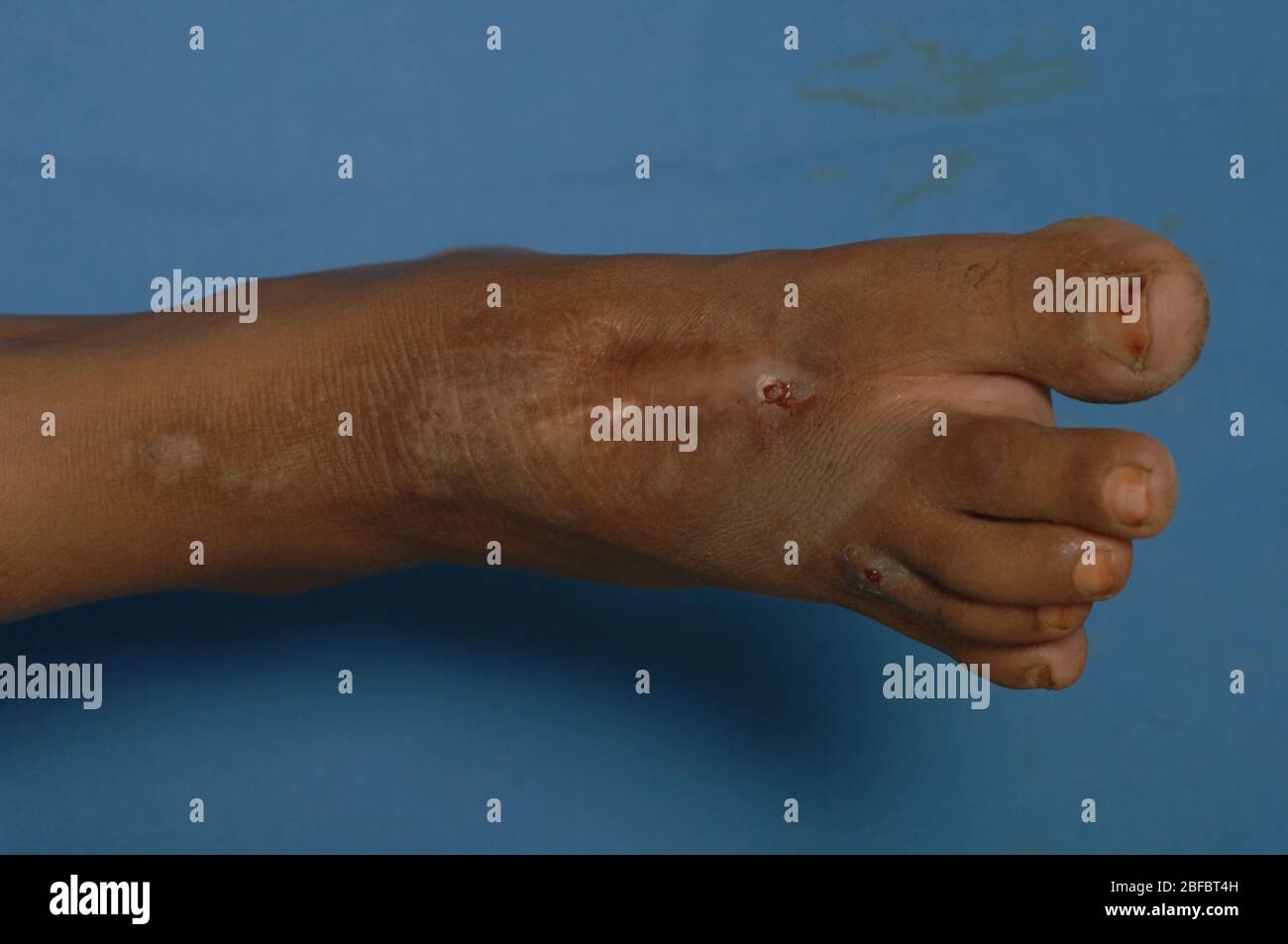 Mycetoma on the right right foot of a patient. Mycetoma is an uncommon ...