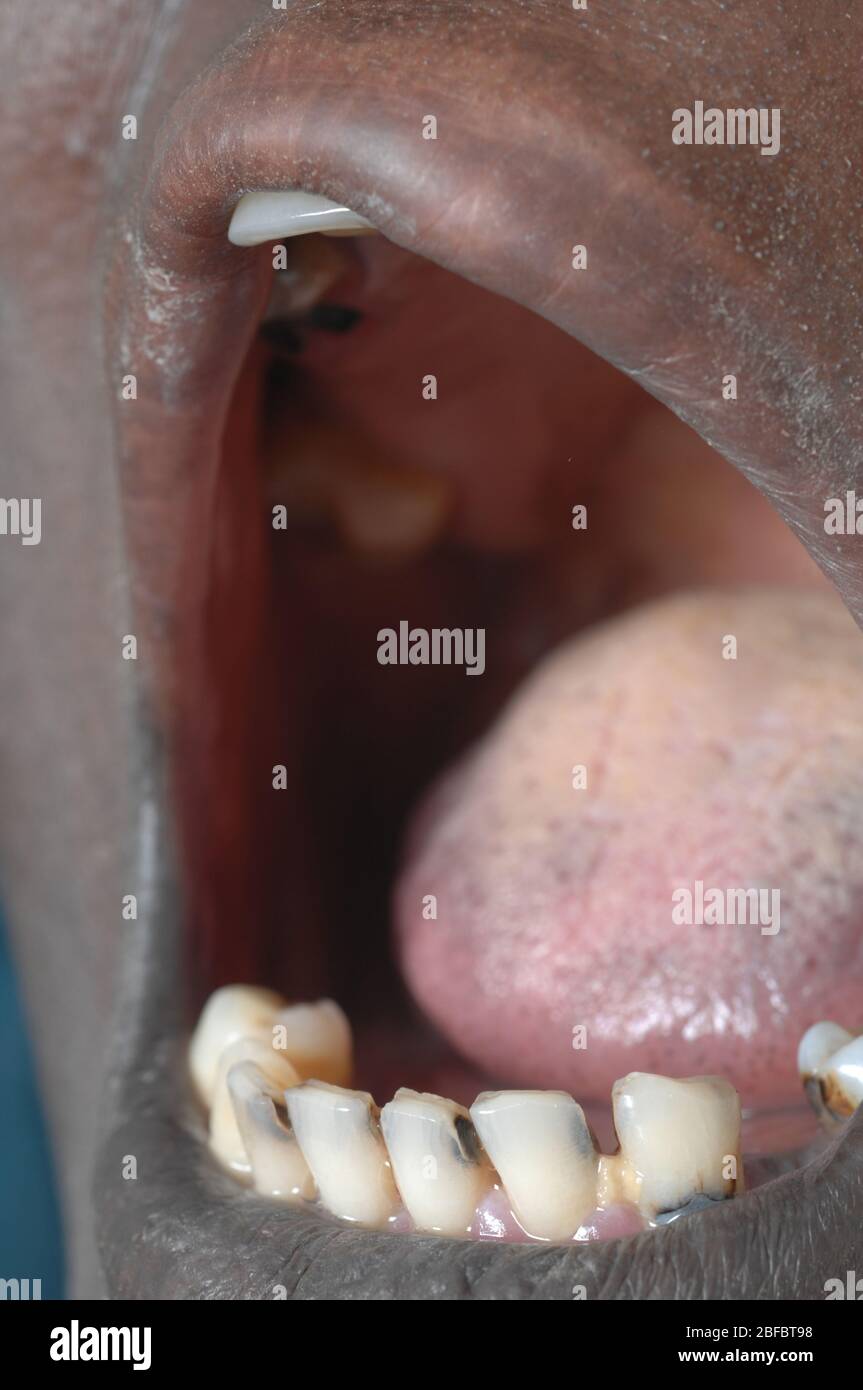 Soft tissue hi-res stock photography and images - Alamy