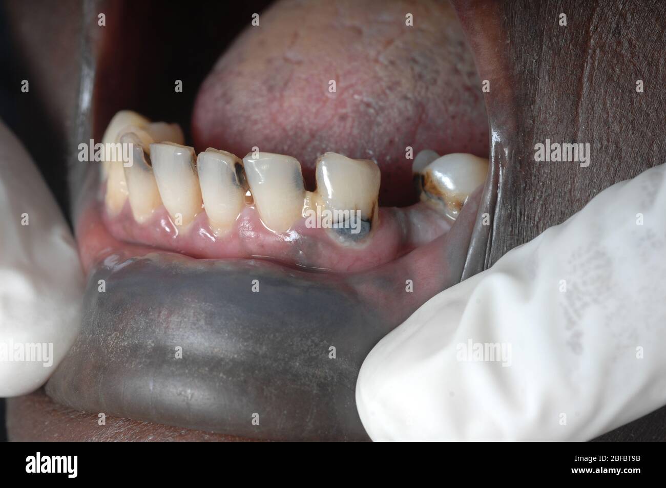 Chronic Periodontitis. The most common type of gum disease ...