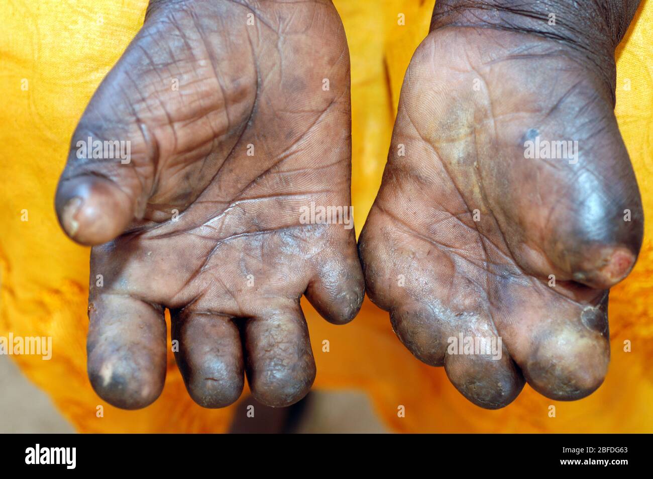 Leprosy hands hi-res stock photography and images - Alamy