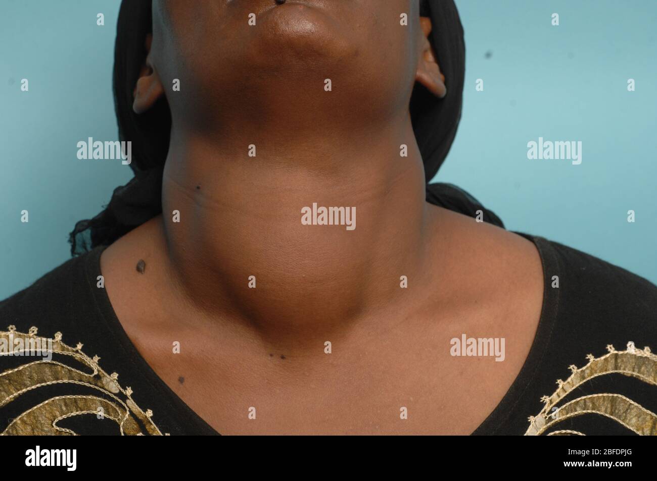 Close up of a woman suffering from a multi-nodula goitre Stock Photo ...