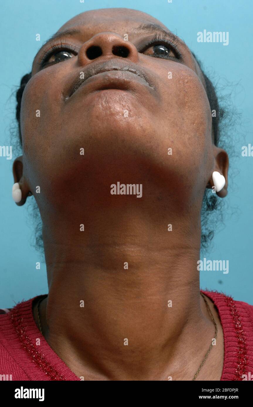 Enlarged goitre hi-res stock photography and images - Alamy